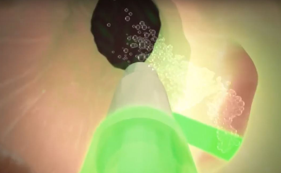 Bph Laser Therapy With Greenlight Laser For Enlarged Prostate